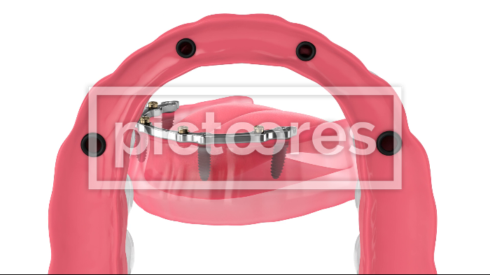 Bar retained removable overdenture installation on implants