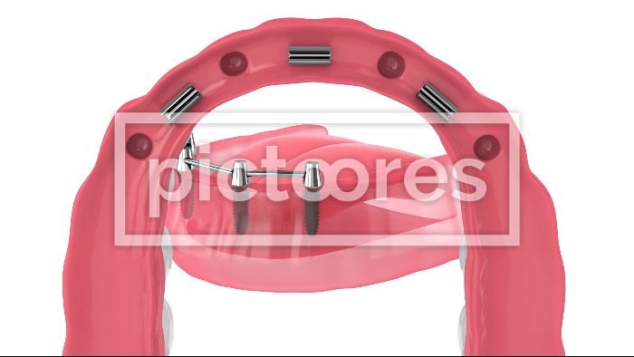 Removable overdenture installation on bar clip attachment