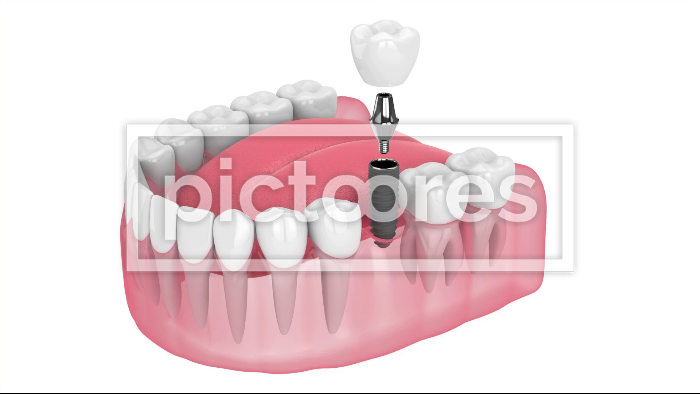 Lower jaw with dental implant installation procedure