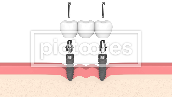 Dental bridge supported by implants installed in human gums