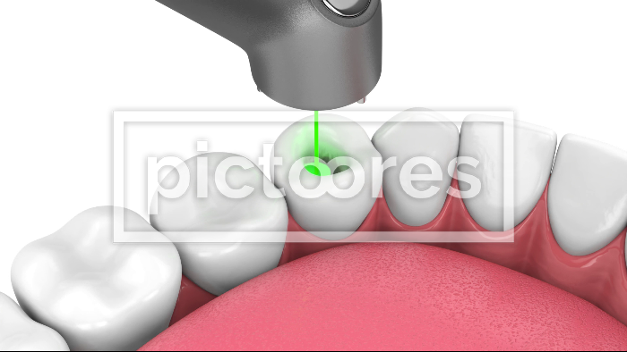 Removing tooth decay with dental laser