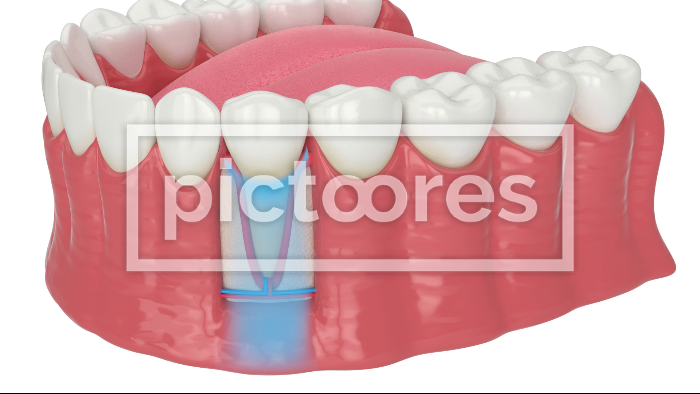 Human jaw with intraligamentary anesthesia procedure