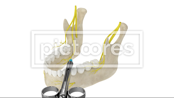 Mandibular arch with inferior alveolar nerve block