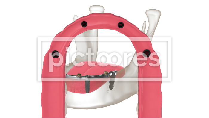 Removable overdenture supported by implants