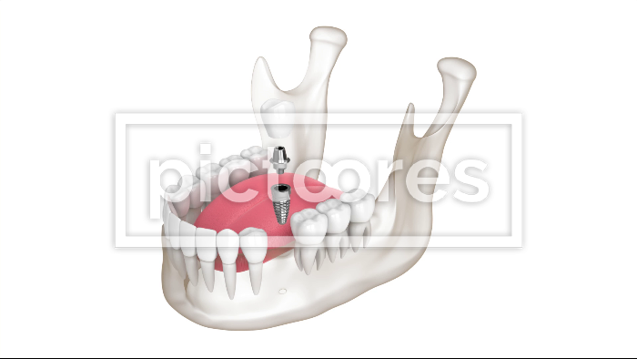 Mandible with dental implant placement