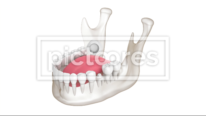 Reshaped tooth with dental crown