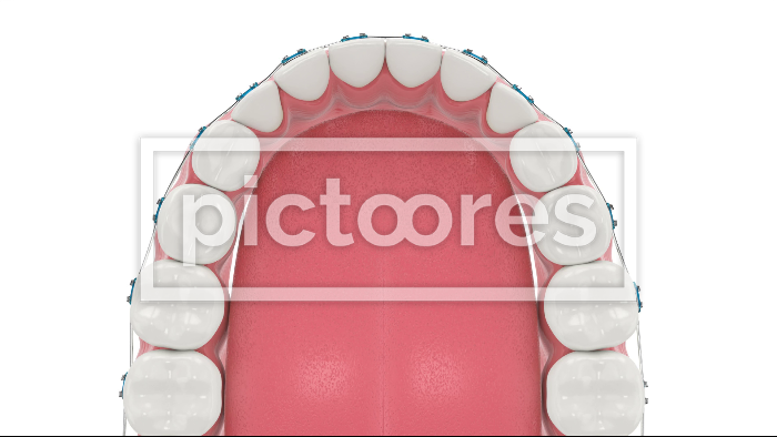 Teeth alignment by orthodontic braces