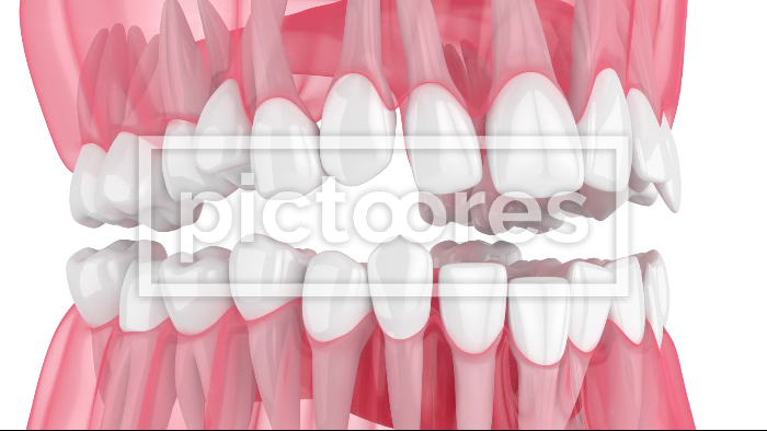 Human jaw with crooked teeth straightening