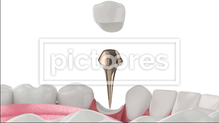 Lower jaw with cast post and core premolar tooth restoration