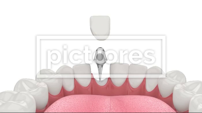 Premolar restoration with cast post and core