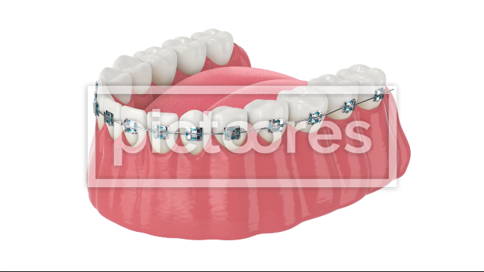 Teeth alignment by orthodontic braces