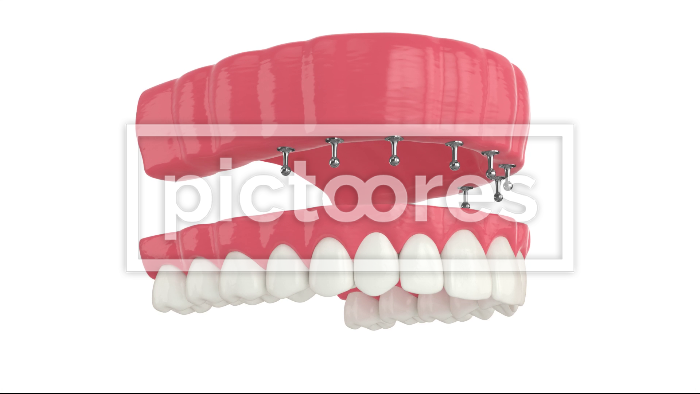 Removable snap-on full implant denture installation