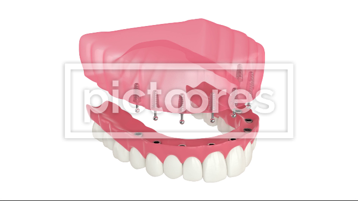 Removable snap-on full implant denture installation
