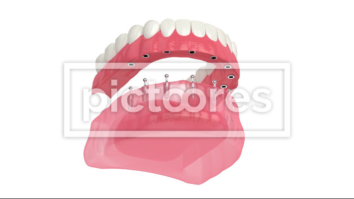 Removable snap-on full implant denture installation