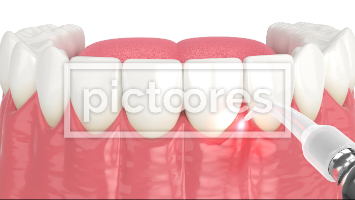 Dental diode laser used to treat gums