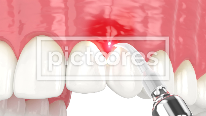 Dental diode laser used to treat gums