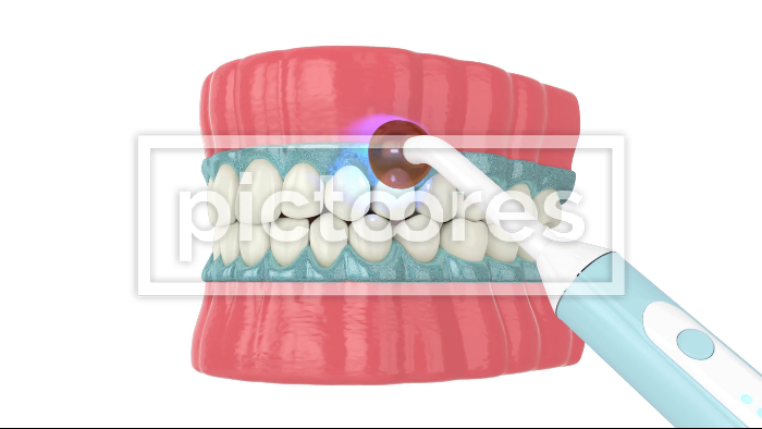 Professional teeth bleaching