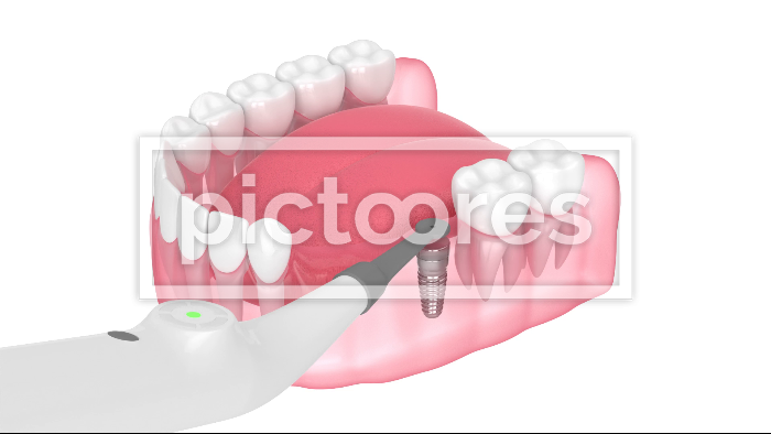 Smart implant detector helping to locate buried healing cap