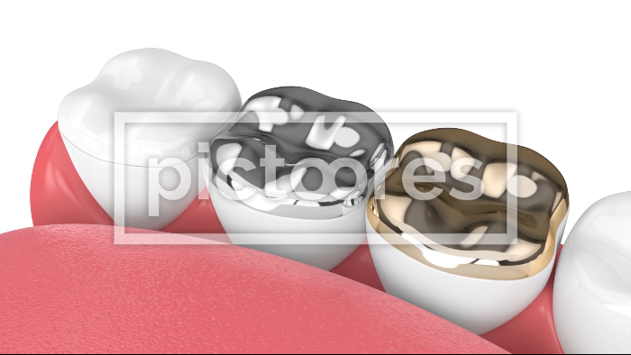 Different types of dental onlay filling