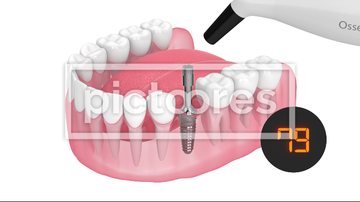 Checking dental implant stability by osseointegration monitoring device