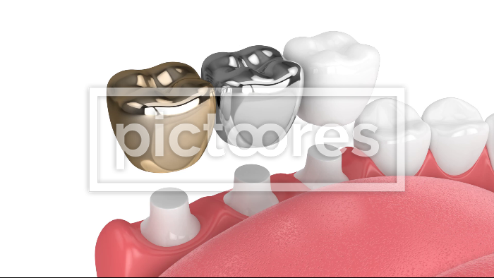 Different types of dental crown filling