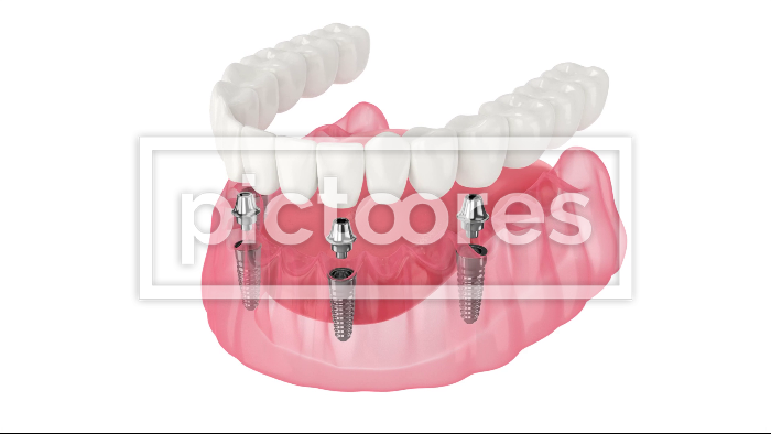 Mandibular prosthesis all-on-4 system supported by implants