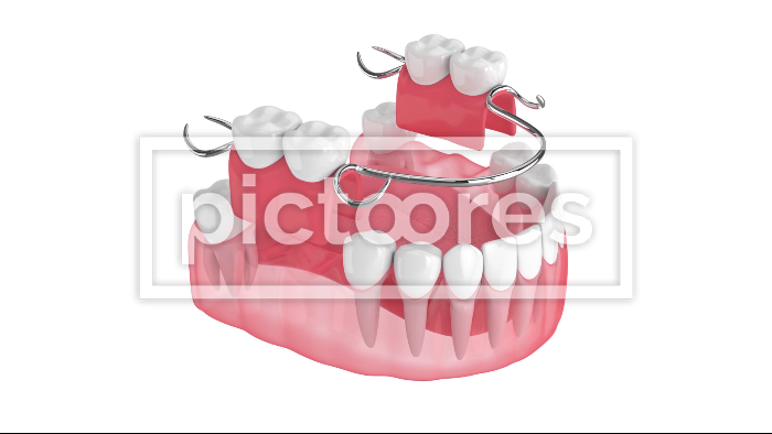 Removable partial denture