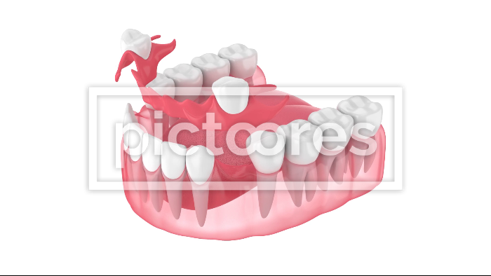 Jaw with removable partial denture