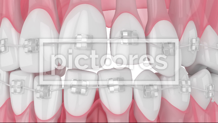 Orthodontic treatment with clear braces
