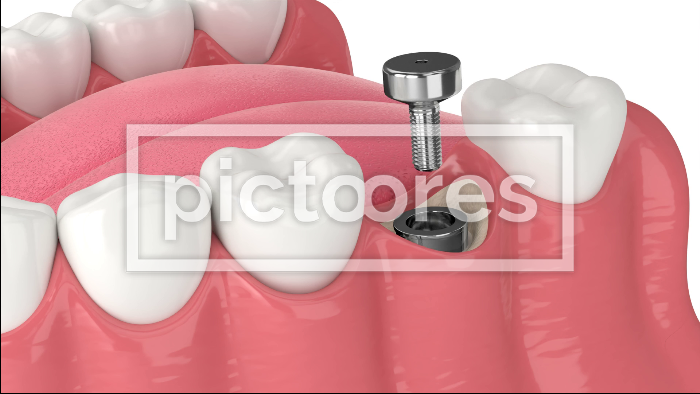 Tooth extraction and implant installation