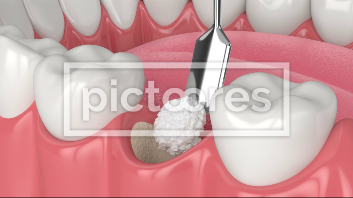 Dental bone grafting and bone augmentation procedure