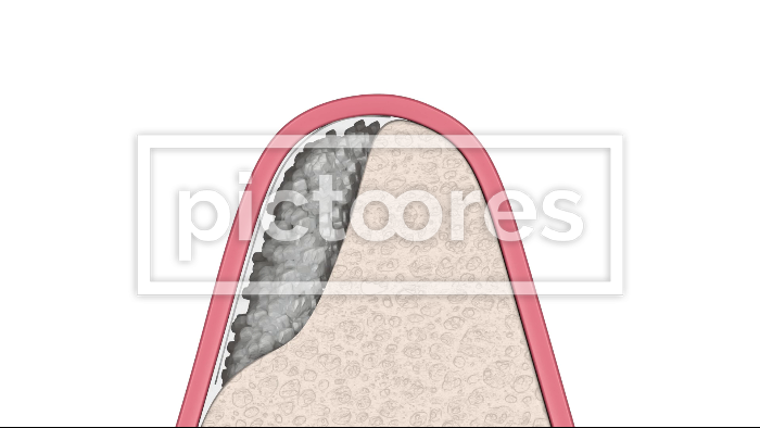 Dental bone grafting preparation for dental implant installation