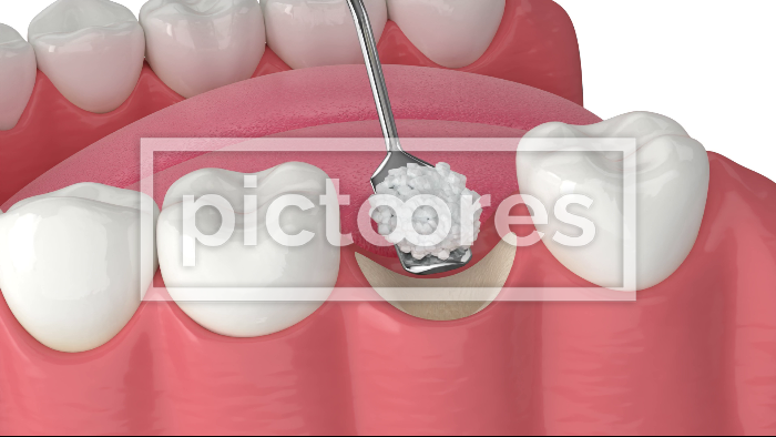 Dental bone grafting and bone augmentation procedure