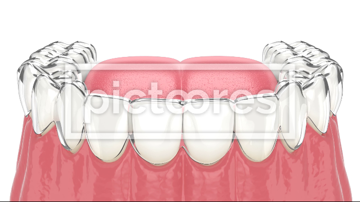 Clear orthodontic aligner on lower jaw