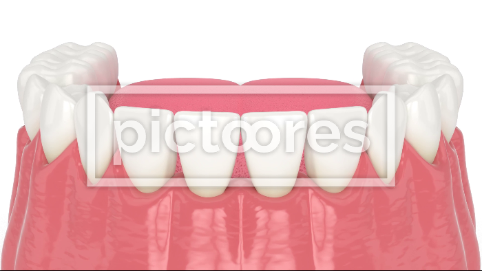Human lower jaw with open gingival embrasure