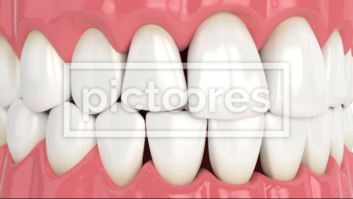Human jaw with open gingival embrasure