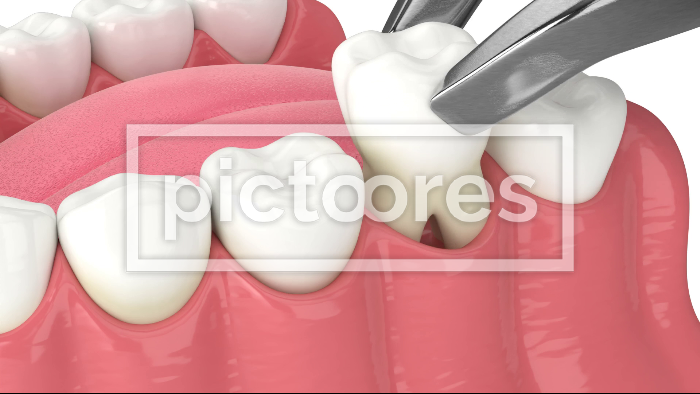 Jaw bone recession after tooth extraction