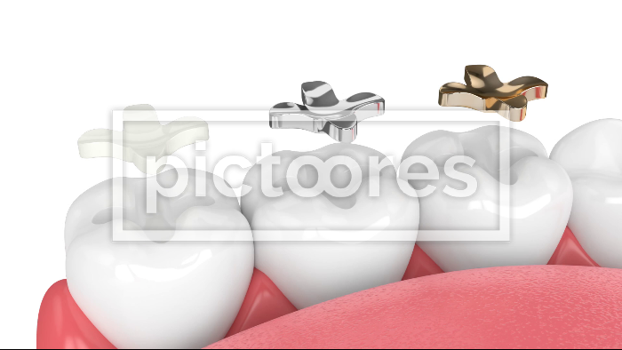Teeth in jaw with three different types of dental inlay filling