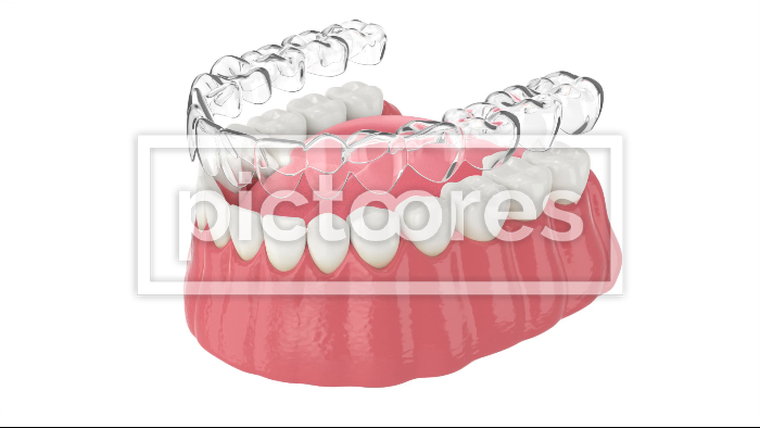 Clear removable aligner placement on lower jaw