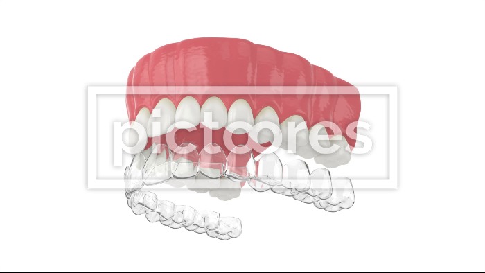 Clear removable aligner placement on upper jaw
