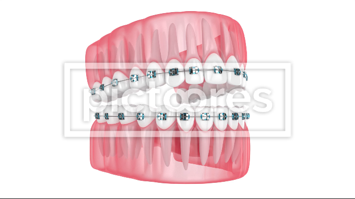 Jaw with teeth and stainless steel orthodontic braces