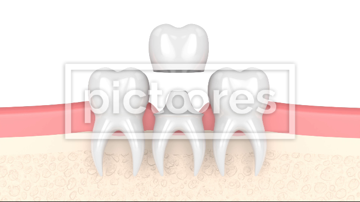 Gums with dental composite crown filling