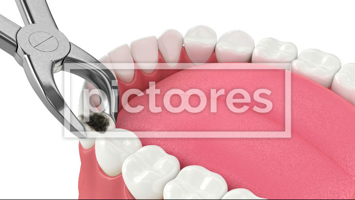 Tooth extraction by dental forceps