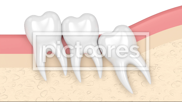 Gums with wisdom tooth mesial causing crowding