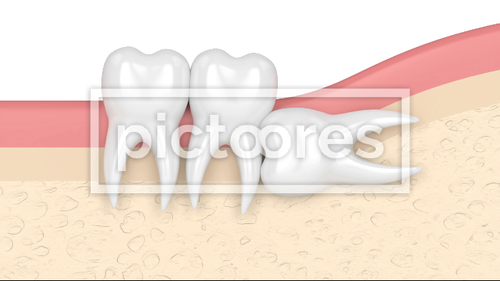 Teeth in gums with wisdom tooth horizontal impaction