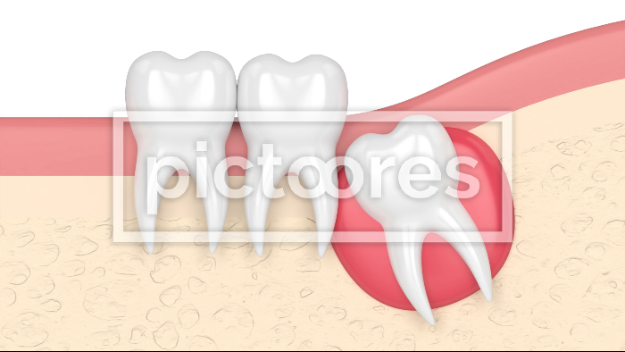 Gums with teeth and wisdom cyst