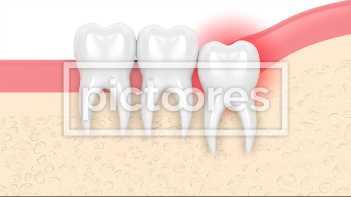 Wisdom vertical impaction causing pain