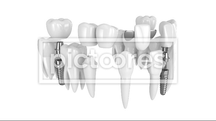 Toothing with different types of teeth rebuilding