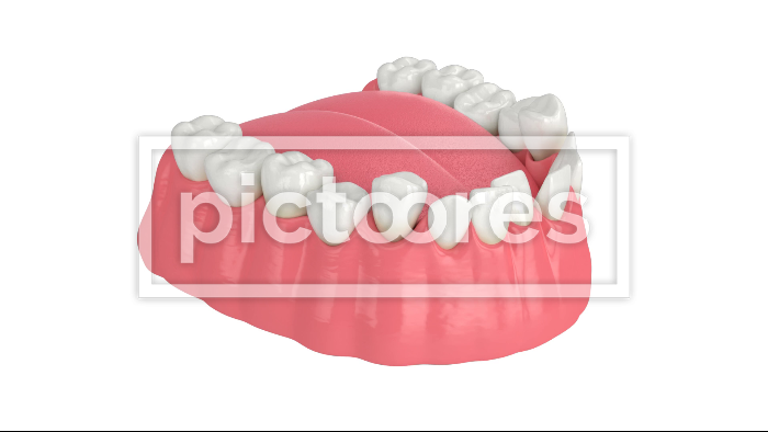 Jaw with straightening of crooked teeth