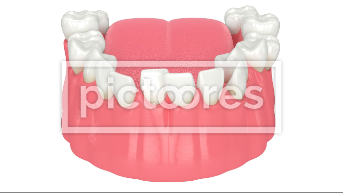 Lower jaw with abnormal teeth position